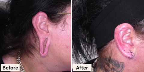 Earlobe Repair Treatment | Stretched, Ripped & Ear Stretching Surgery ...