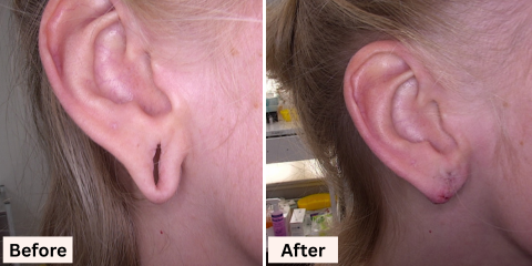 Earlobe Repair Treatment | Stretched, Ripped & Ear Stretching Surgery ...