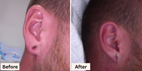 Earlobe Repair Treatment | Stretched, Ripped & Ear Stretching Surgery ...